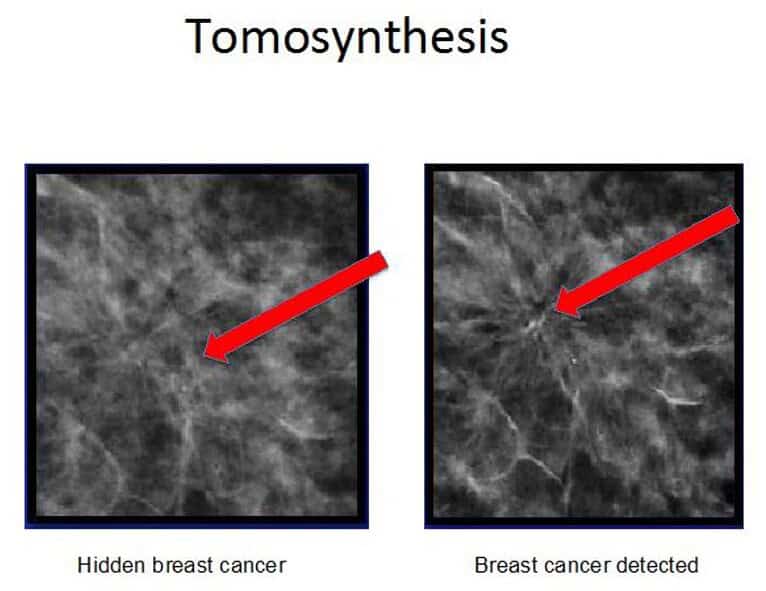 Breast Cancer Statistics By Types, Stage And Occurrence (2025)